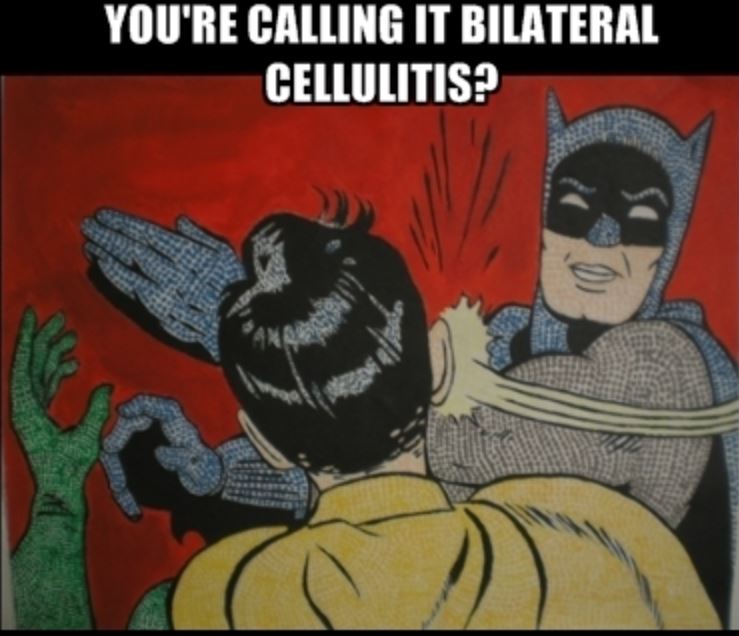 The “Bilateral Cellulitis”